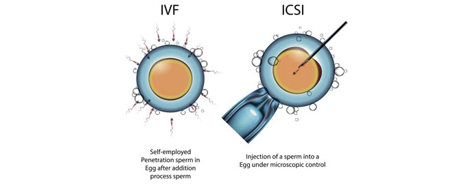 IVF/ICSI